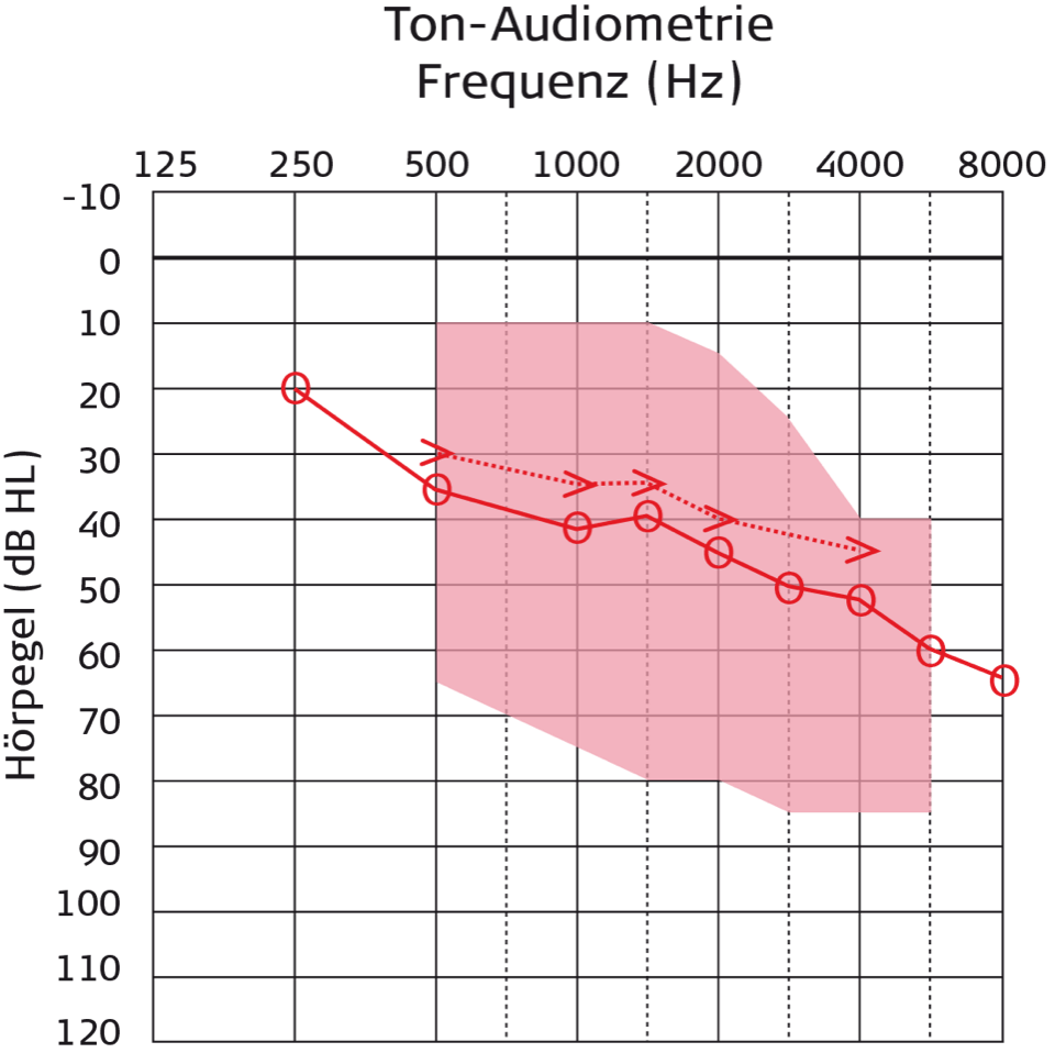 Neugeborenen Hörscreening Ergebnisse verstehen · HörPaten.de